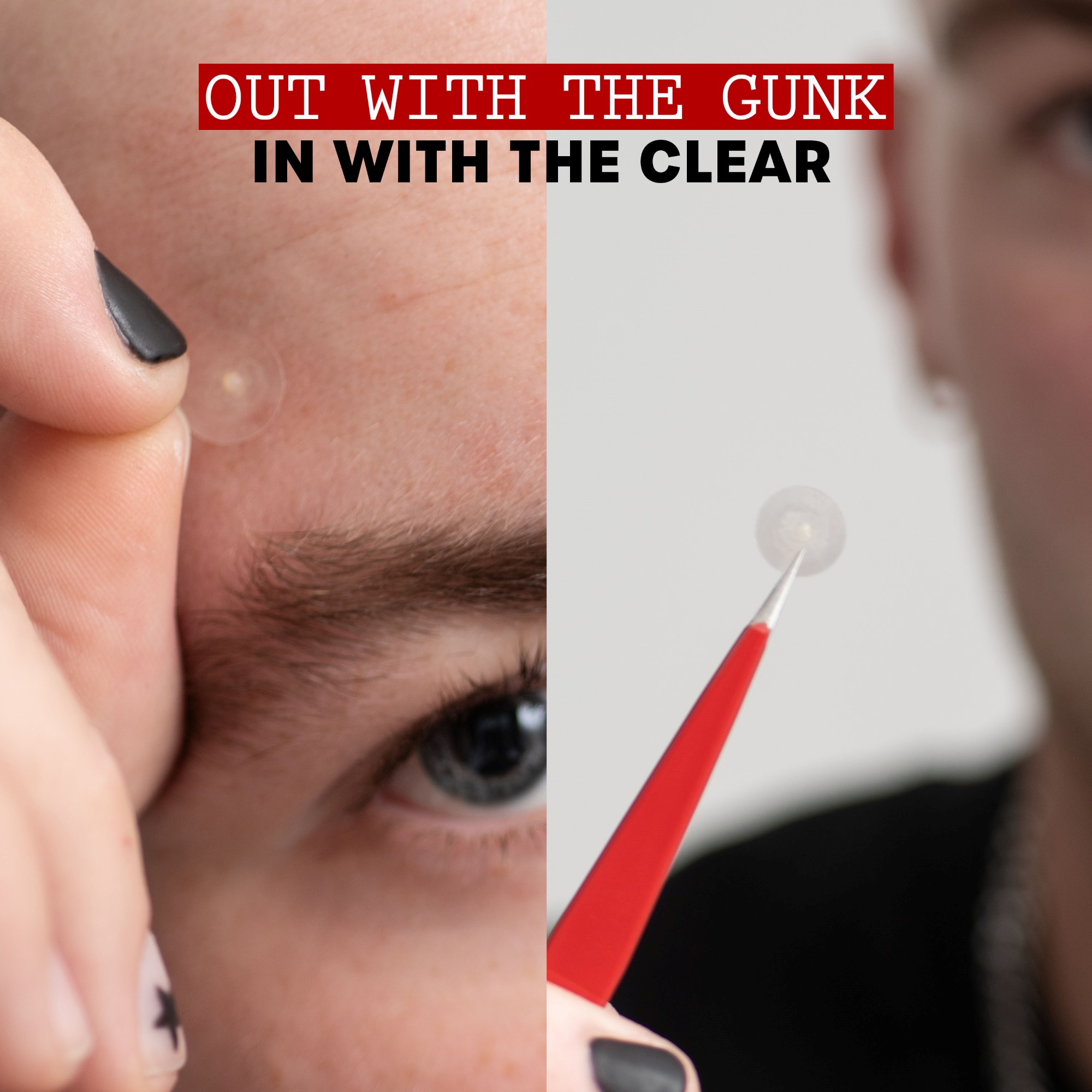 Invisible S.O.S Acne Patch with Hydrocolloid - Thayers